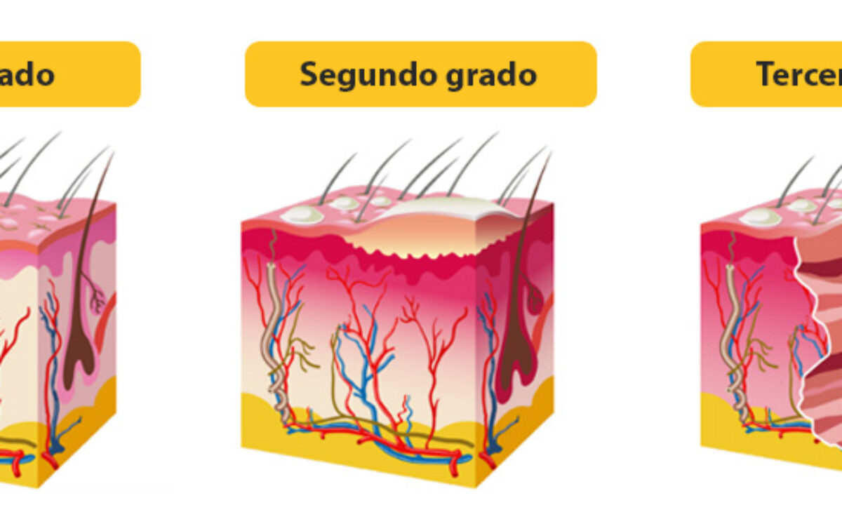 Quemaduras De 1er, 2do Y 3er Grado