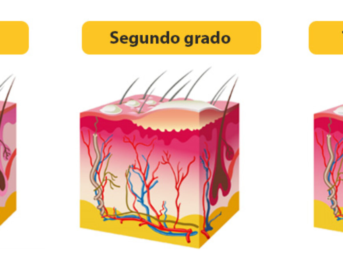 Quemadura Solar De Tercer Grado Tipos De Quemaduras | Gabriela Trejo