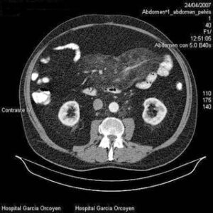 Exudado: Causas, beneficios y qué hacer con él - Revista Úlceras.Info