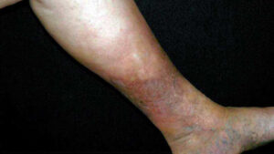 Exudado: Causas, beneficios y qué hacer con él - Revista Úlceras.Info