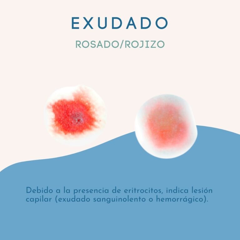 Exudado: Causas, beneficios y qué hacer con él - Revista Úlceras.Info
