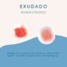 Exudado: cantidad y color para valoración - Revista Úlceras.Info