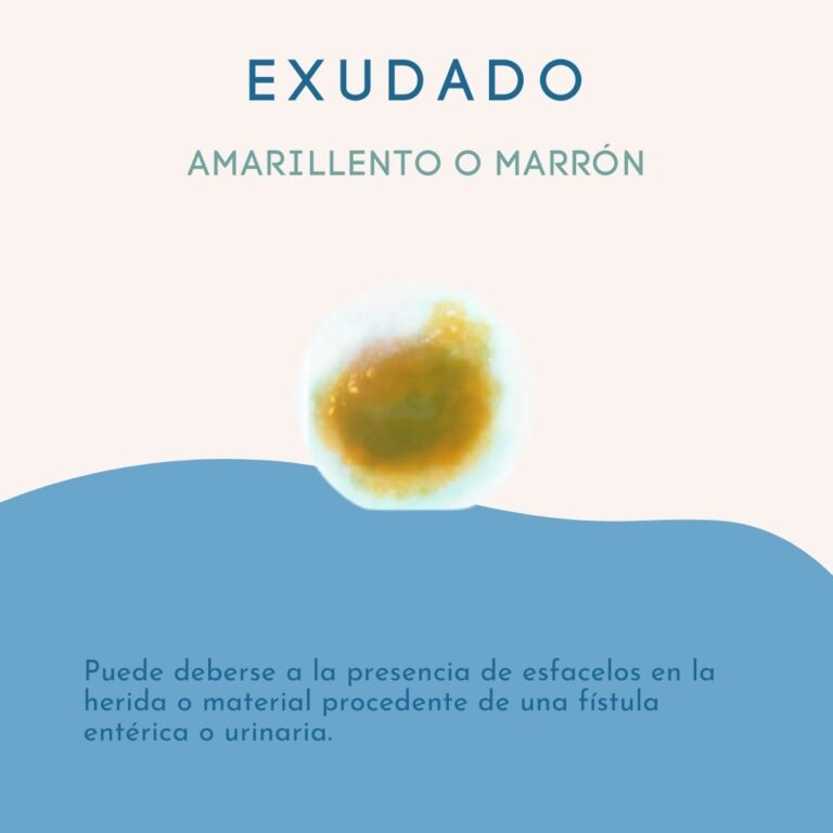 Exudado: Causas, beneficios y qué hacer con él - Revista Úlceras.Info