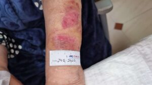 Dermatitis de estasis: a propósito de un caso - Revista Úlceras.Info