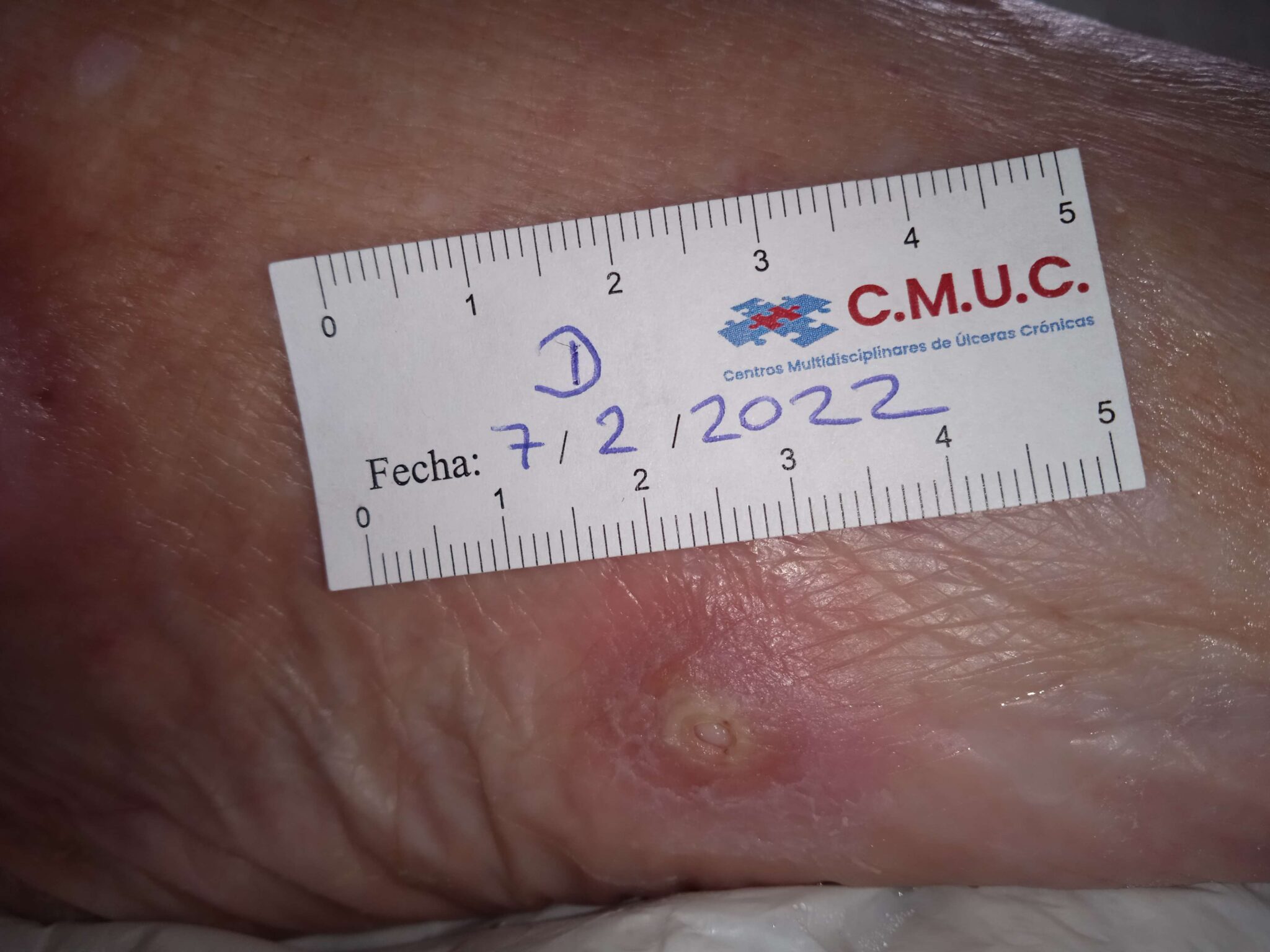 Casos Clínicos de úlceras por presión - Revista Úlceras.Info