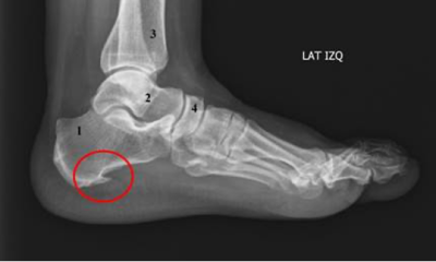 Tipos de exudado en heridas: señales, riesgos y tratamientos ...